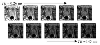Multi-echo spin echo prostate images for T2 mapping